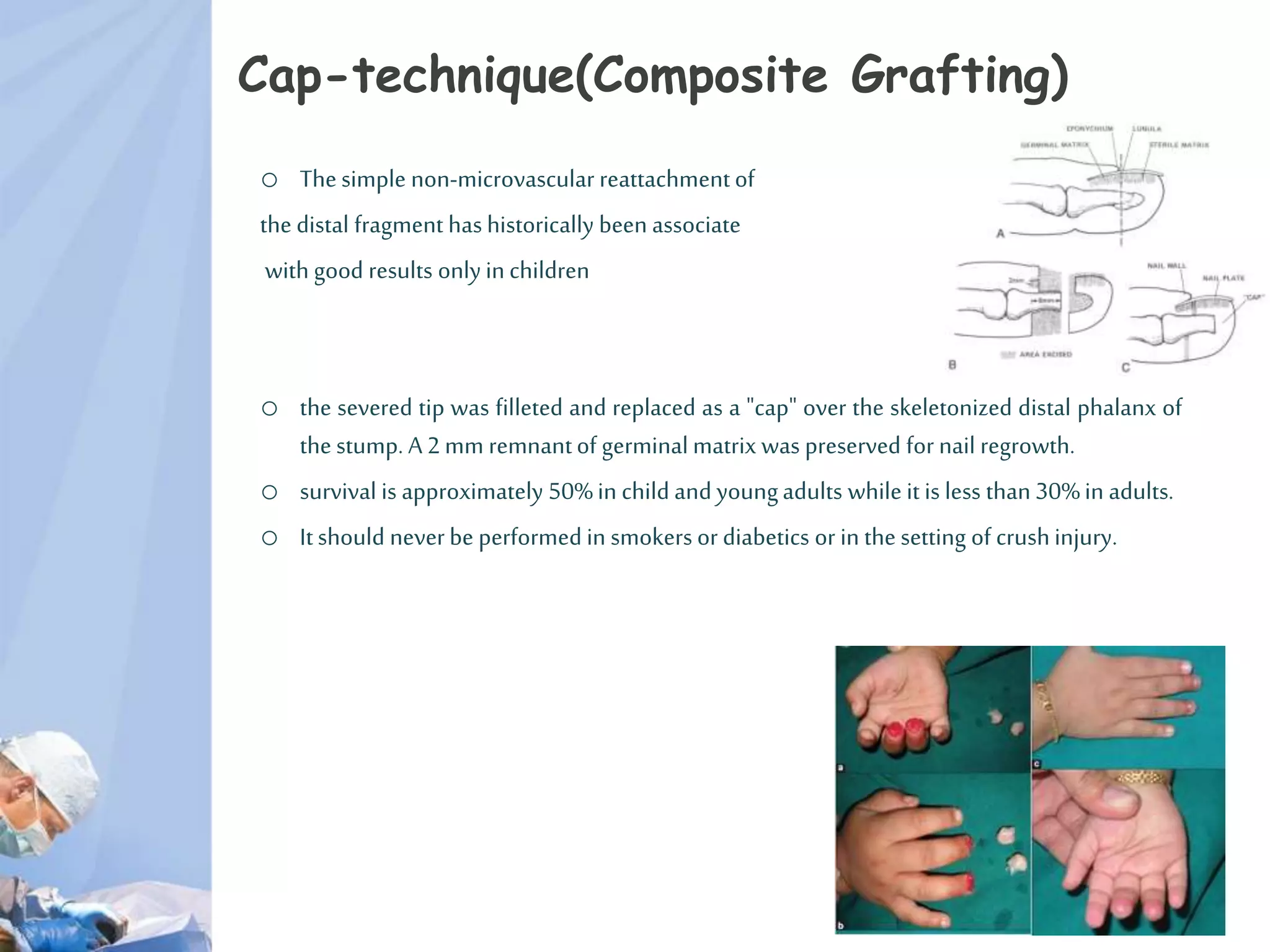 Finger tip injury | PPTX