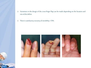 Finger tip injury | PPTX