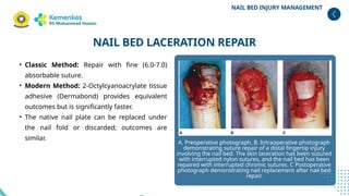 finger tip injury part 1, orthopaedic, medical surgery | PPTX
