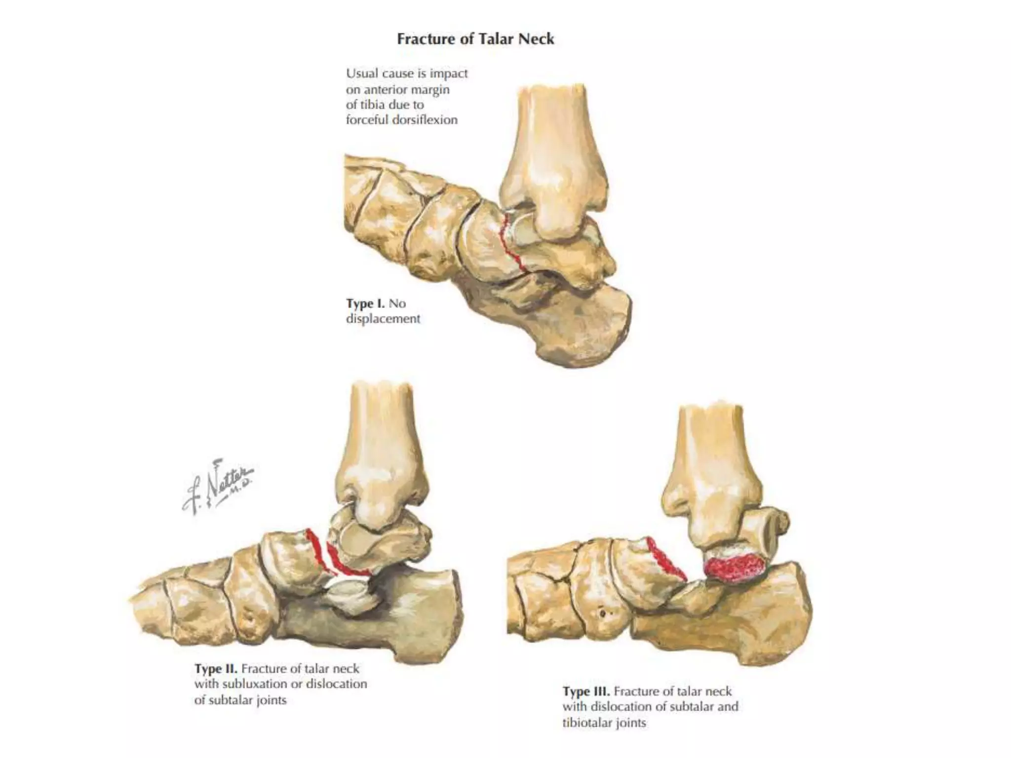 Fingertip Injury and talar neck fx.pptx