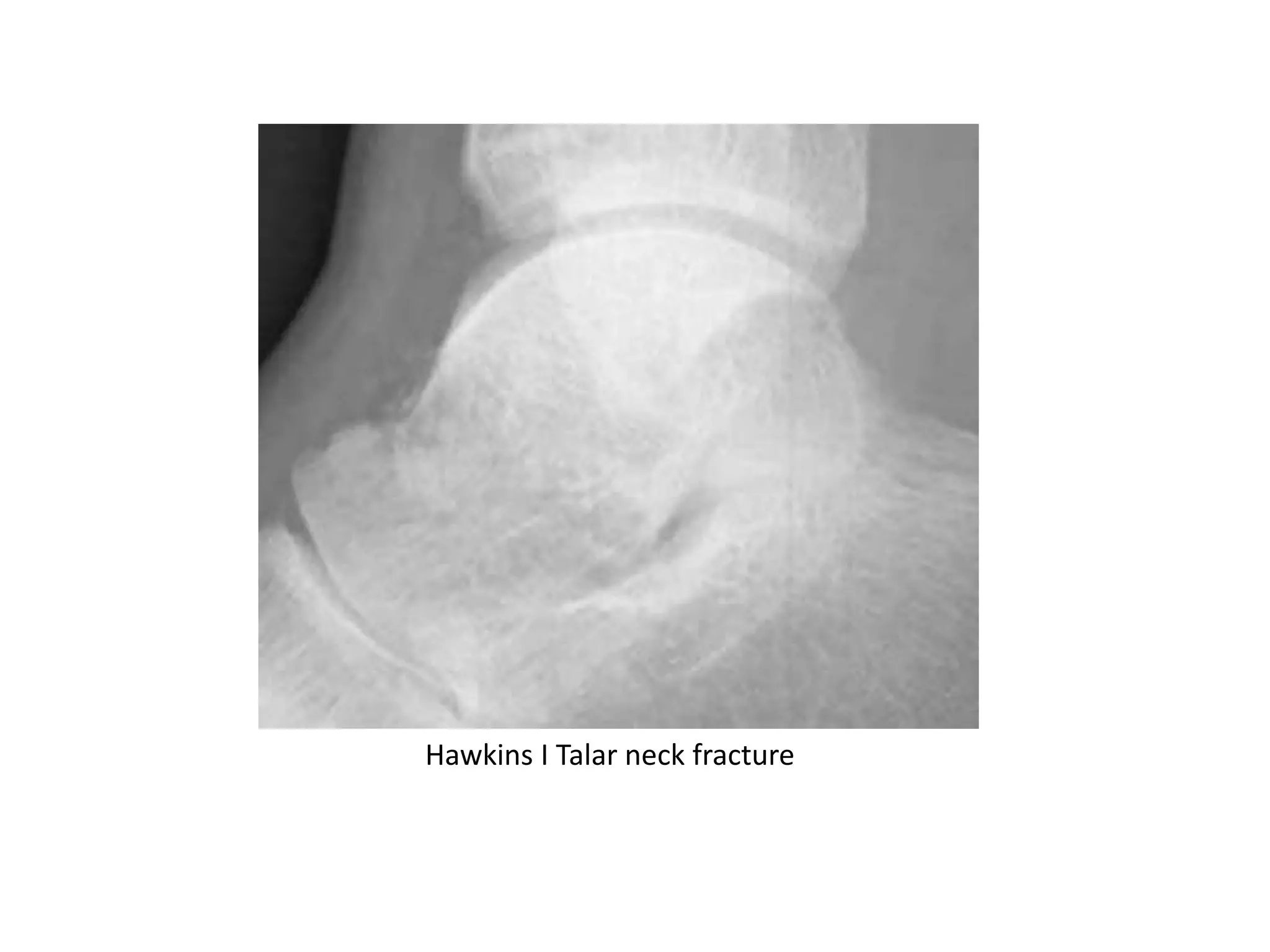 Fingertip Injury and talar neck fx.pptx