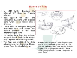 Fingertip recon | PPT