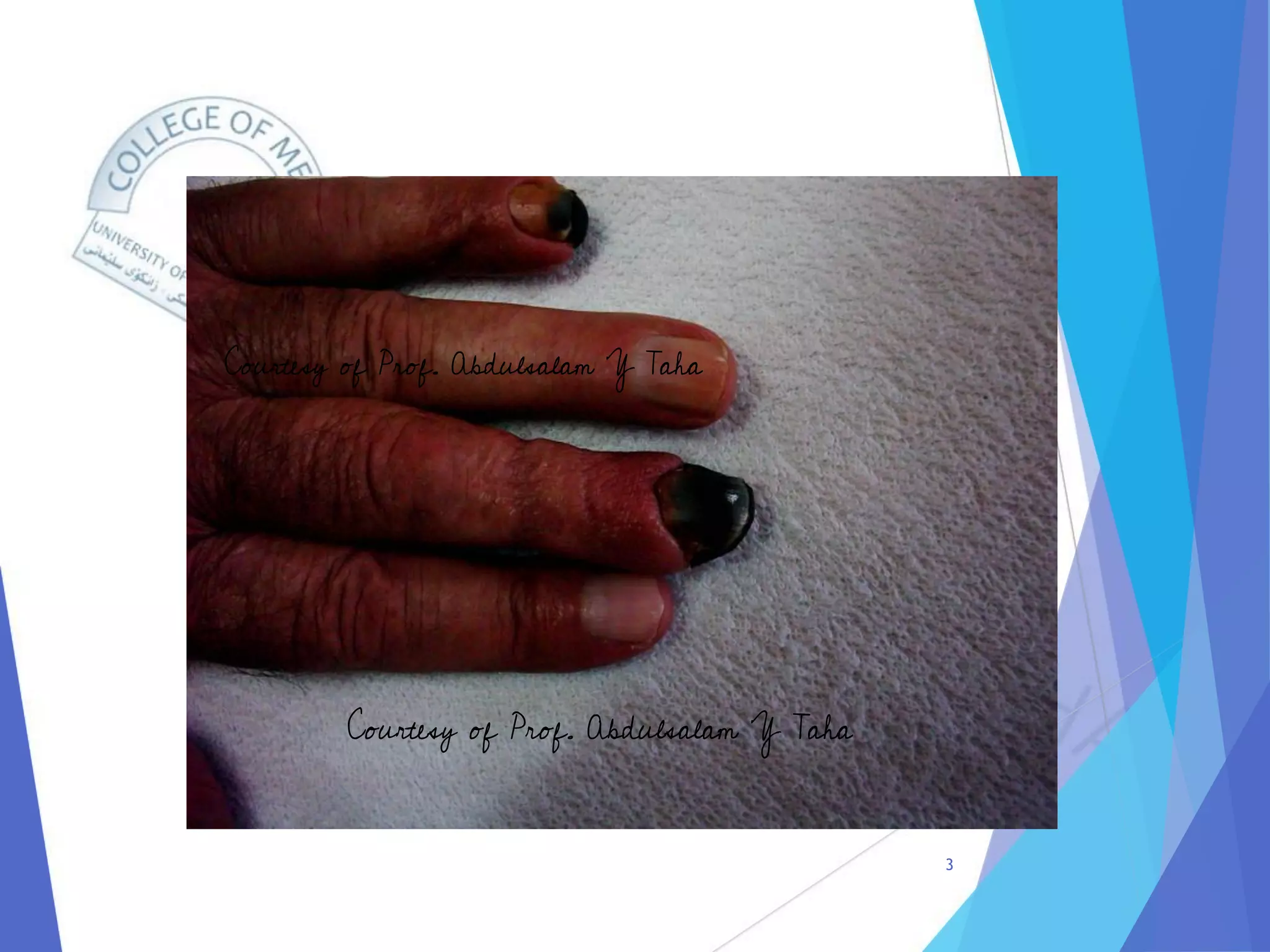 Finger Tips Gangrene with Preserved Radial Pulse.pdf