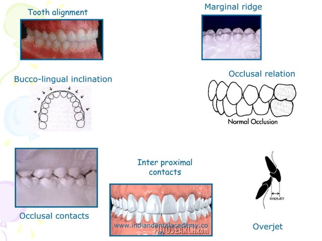 Finishing and detailing in straight wire technique / fixed orthodontics courses | PPT | Dental ...