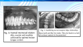 Finishing stage in Orthodontics Treatment.pptx