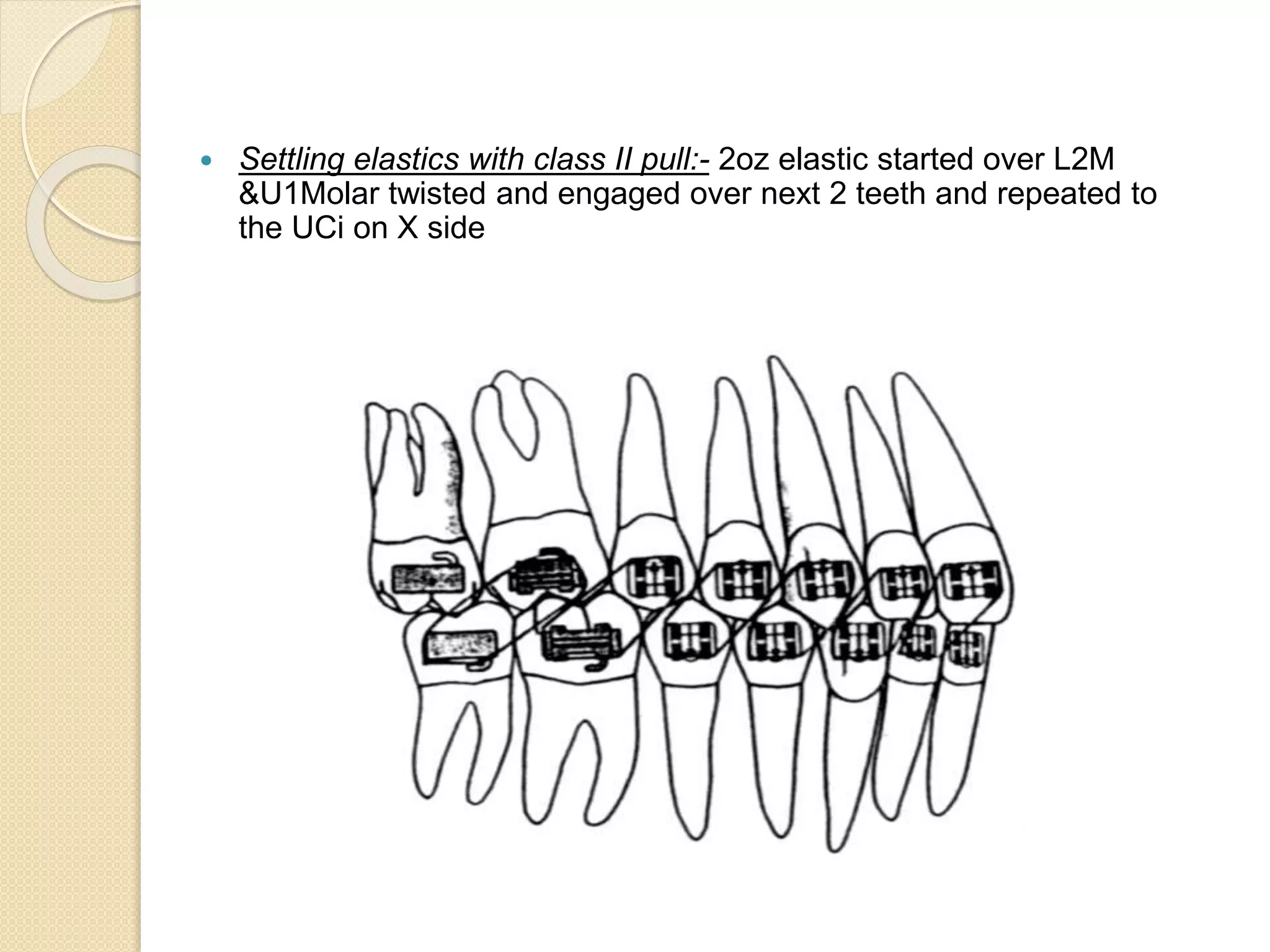 finishing and detailing in orthodontics | PPTX
