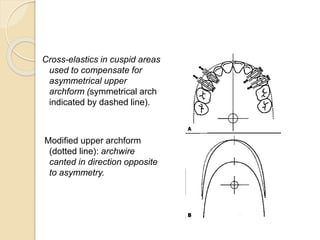 finishing and detailing in orthodontics | PPTX