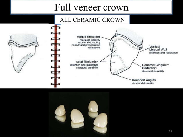 Finish lines (3) final | PPTX | Dental Health | Diseases and Conditions