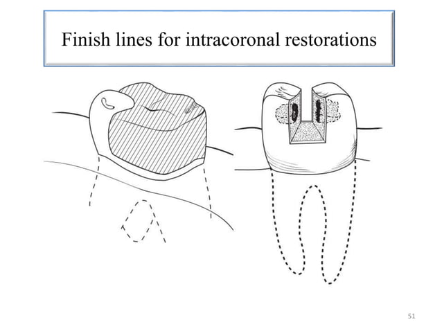 Finish lines (3) final | PPTX | Dental Health | Diseases and Conditions