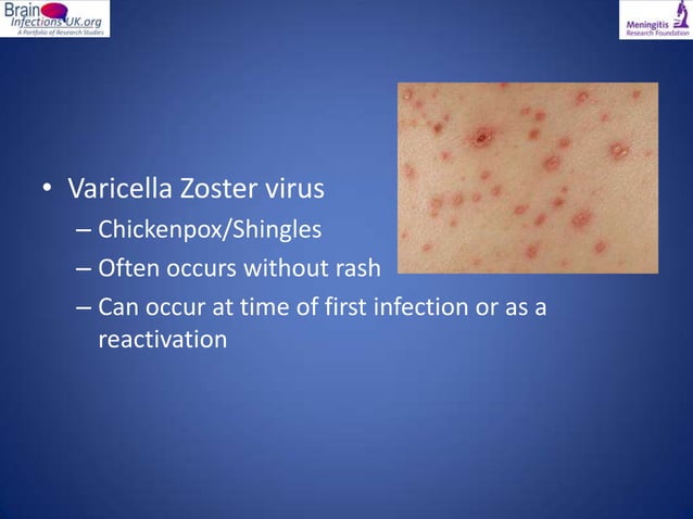 Viral Meningitis: A real pain in the neck by Dr Fiona McGill | PPTX ...