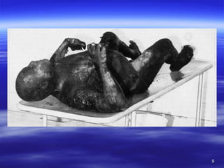 fire and thermal injuries pathology forensics.ppt