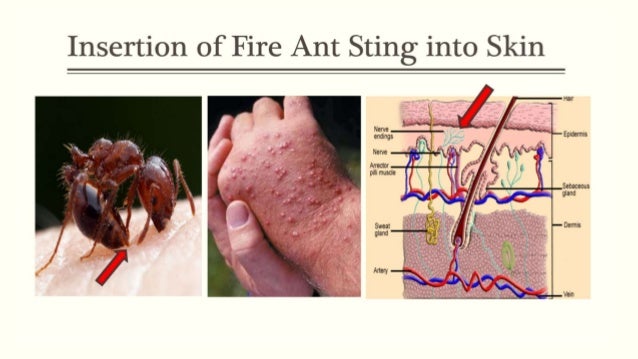 Fire Ant Bites Swelling