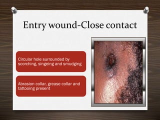 Abrasion Collar Gunshot Wound Entry