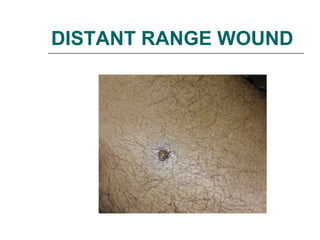 Fire arm injuries | PPT