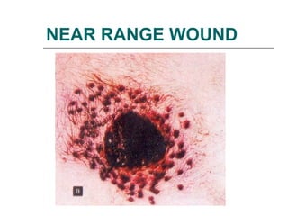 Fire arm injuries | PPT