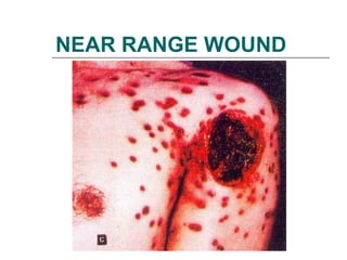 Fire arm injuries | PPT