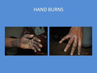 Firecracker Burns Safety | PPT