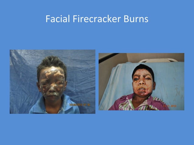 Firecracker Burns Safety | PPT