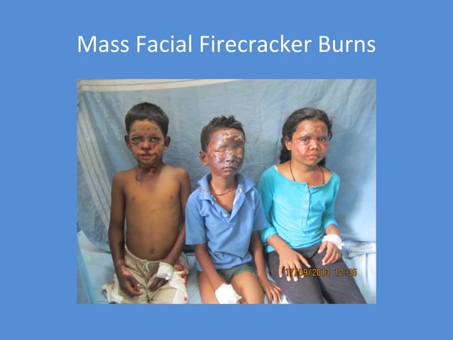 Firecracker Burns Safety | PPT