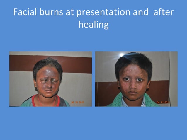 Firecracker Burns Safety | PPT