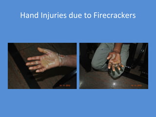 Firecracker Burns Safety | PPT