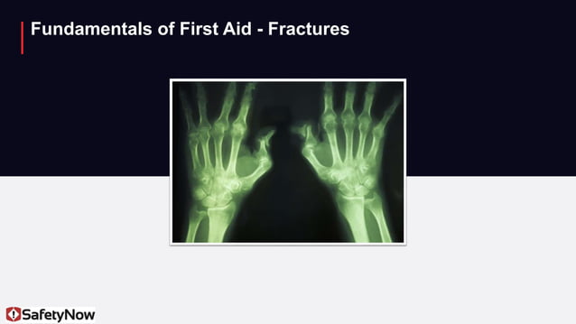 First-Aid-Fractures in healthy care | PPT