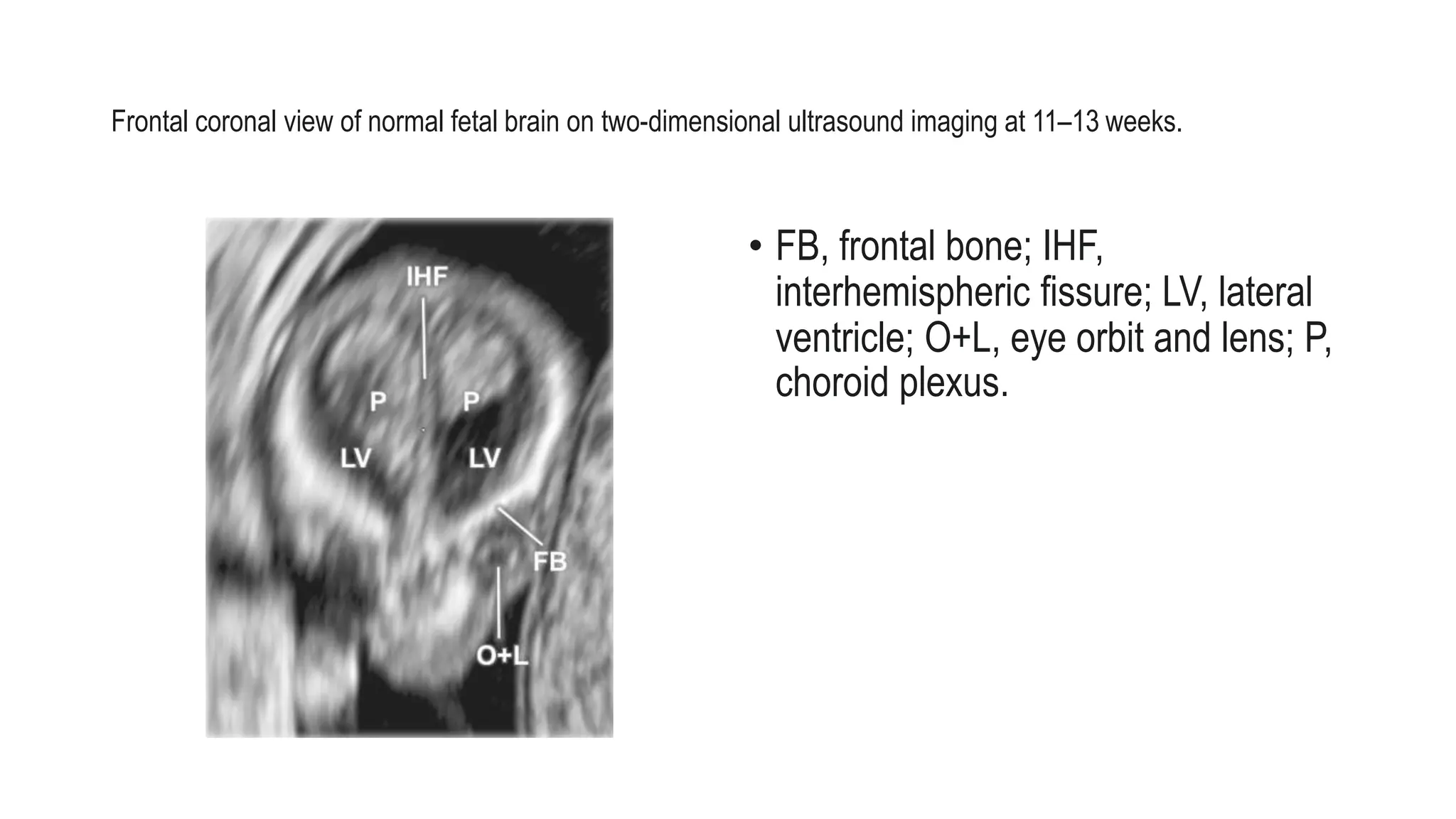 First-trimester fetal neurosonography-DR.BAHRİ.pptx