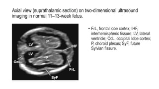 First-trimester fetal neurosonography-DR.BAHRİ.pptx