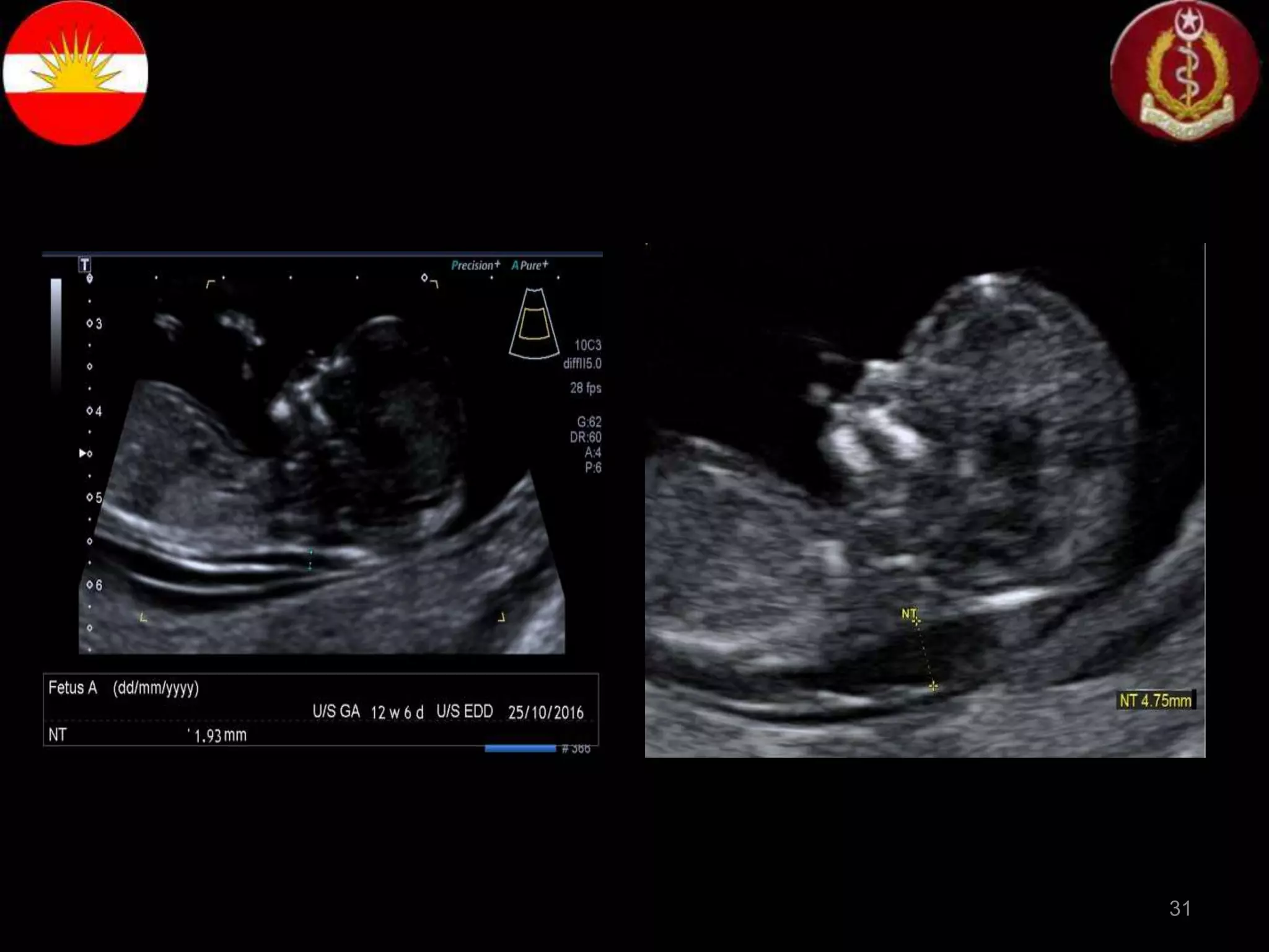 First trimester ultrasound.pptx