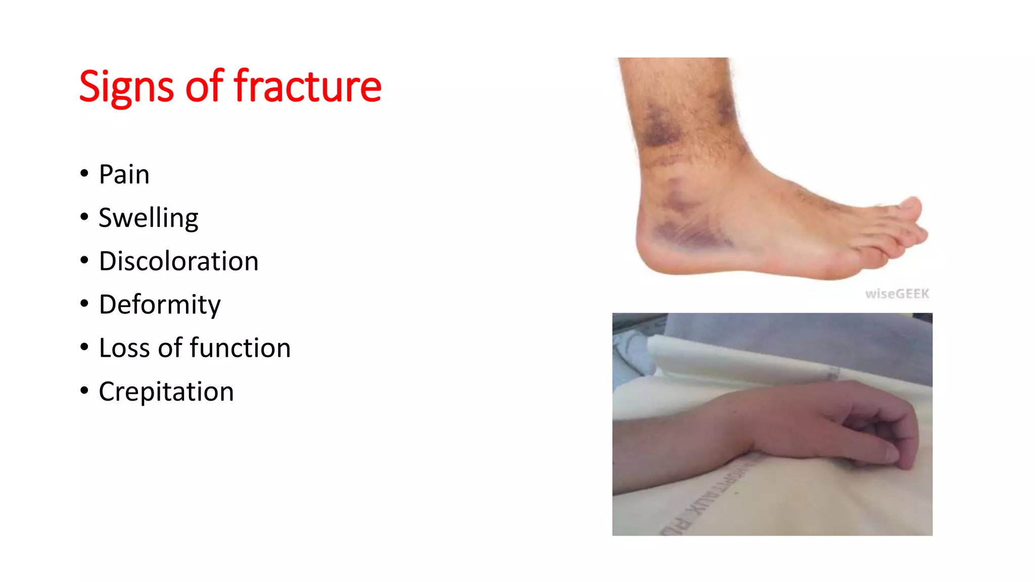Fracture first aid by Dr. Hany Aldakar MD. Orthopedic Surgery and ...