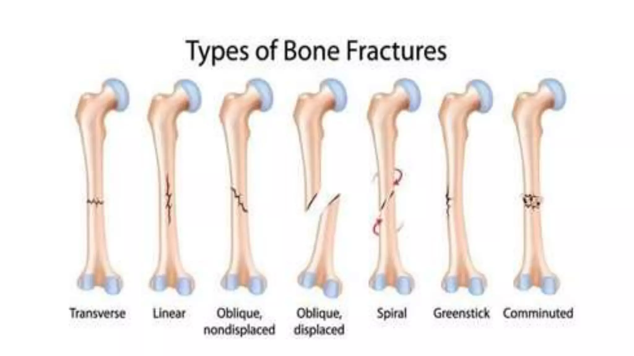 Fracture first aid by Dr. Hany Aldakar MD. Orthopedic Surgery and ...
