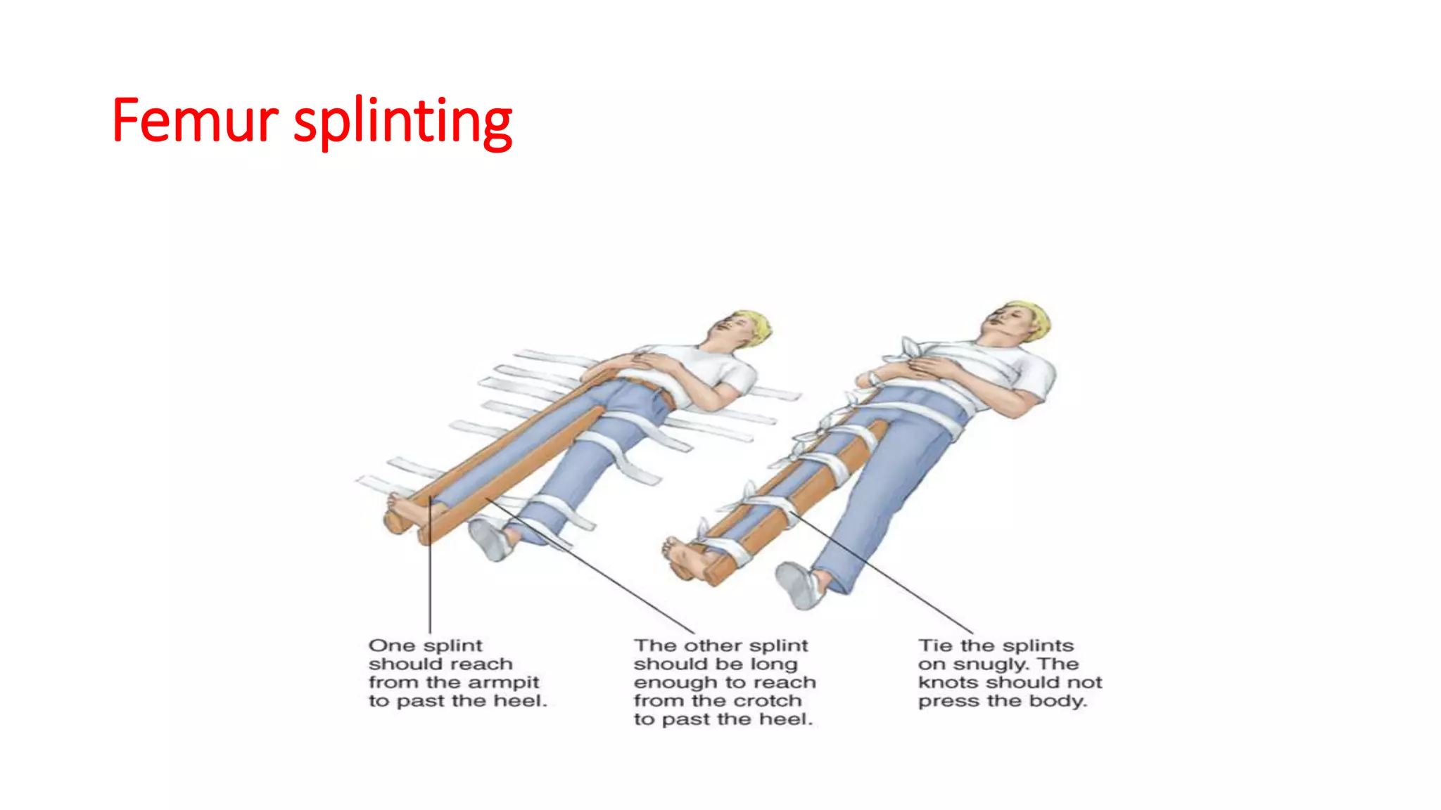 Fracture first aid by Dr. Hany Aldakar MD. Orthopedic Surgery and ...