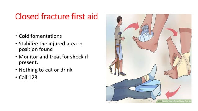 Fracture first aid by Dr. Hany Aldakar MD. Orthopedic Surgery and ...