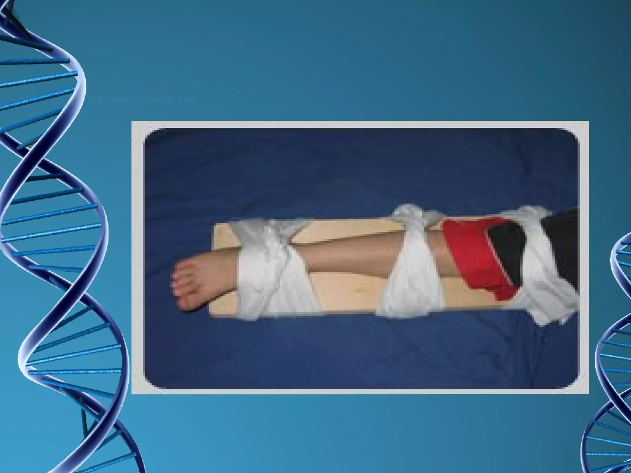 First aid for fracture | PPT