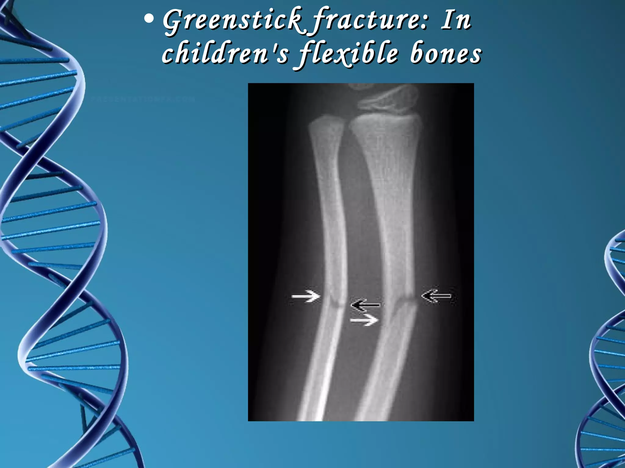 First aid for fracture | PPT