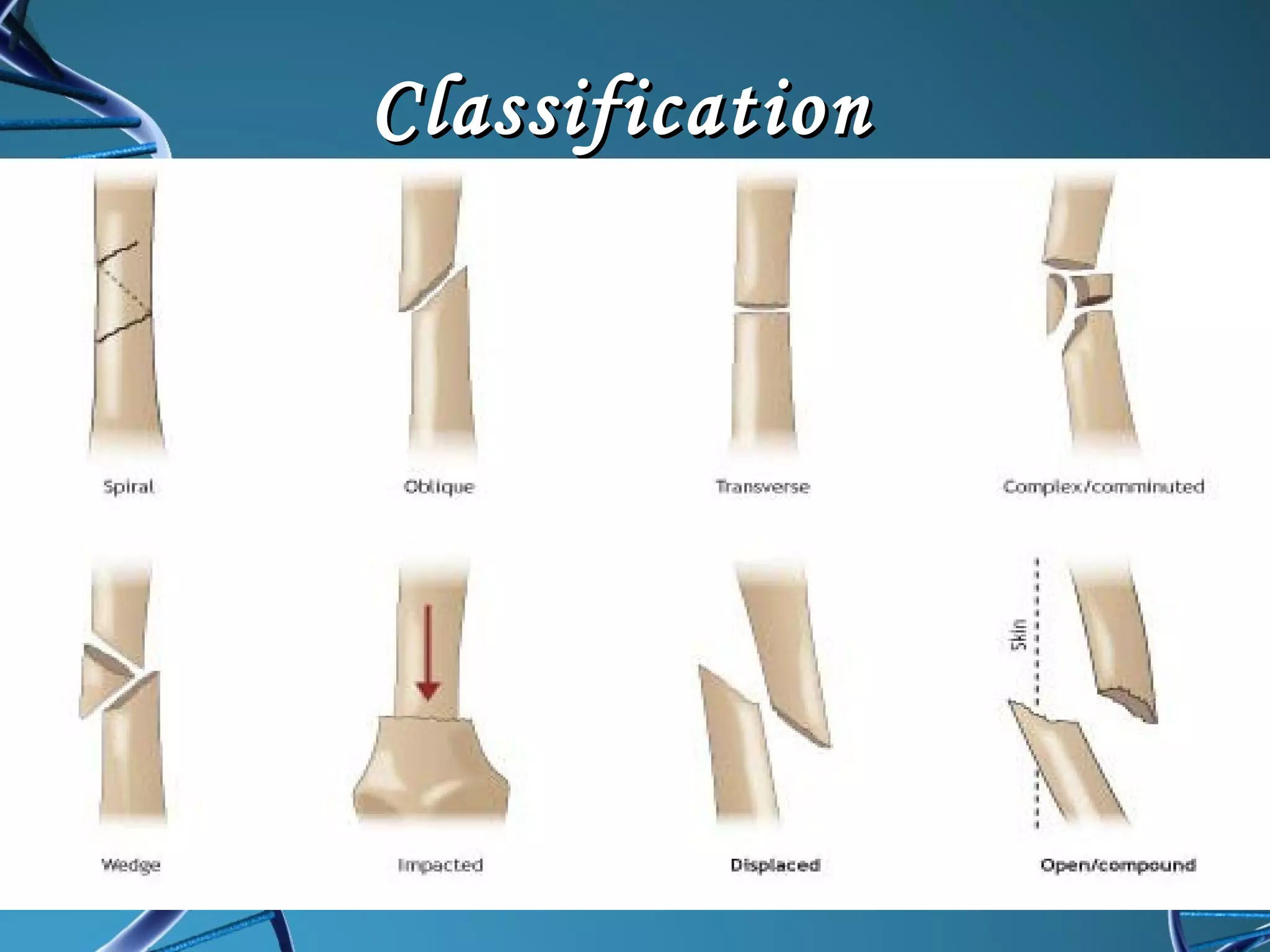 First aid for fracture | PPT