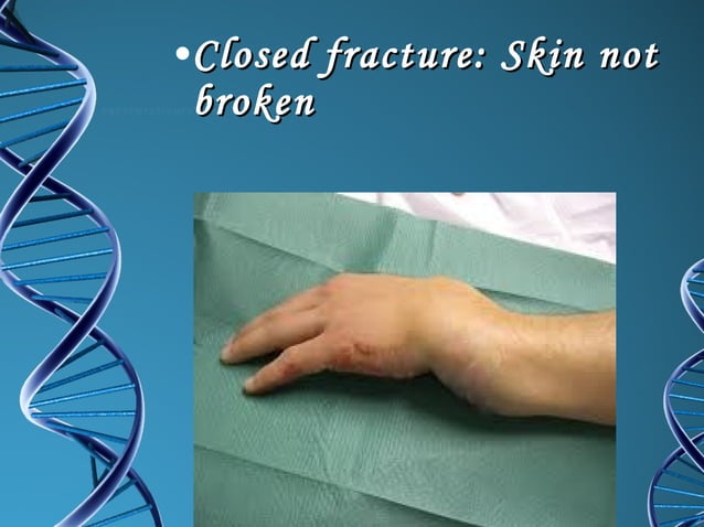 First aid for fracture | PPT