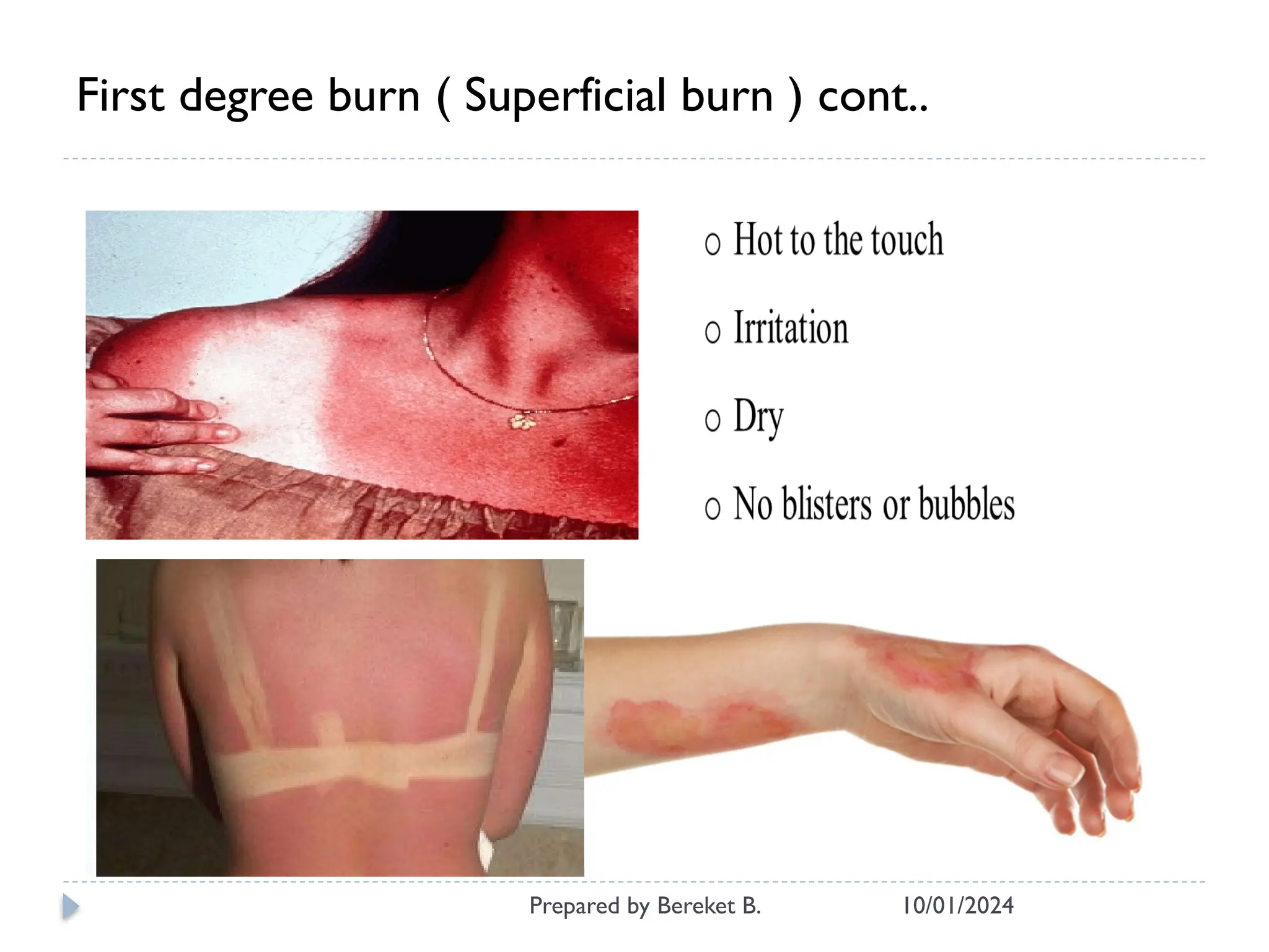 First aid Burn for health science students pptx | PPTX