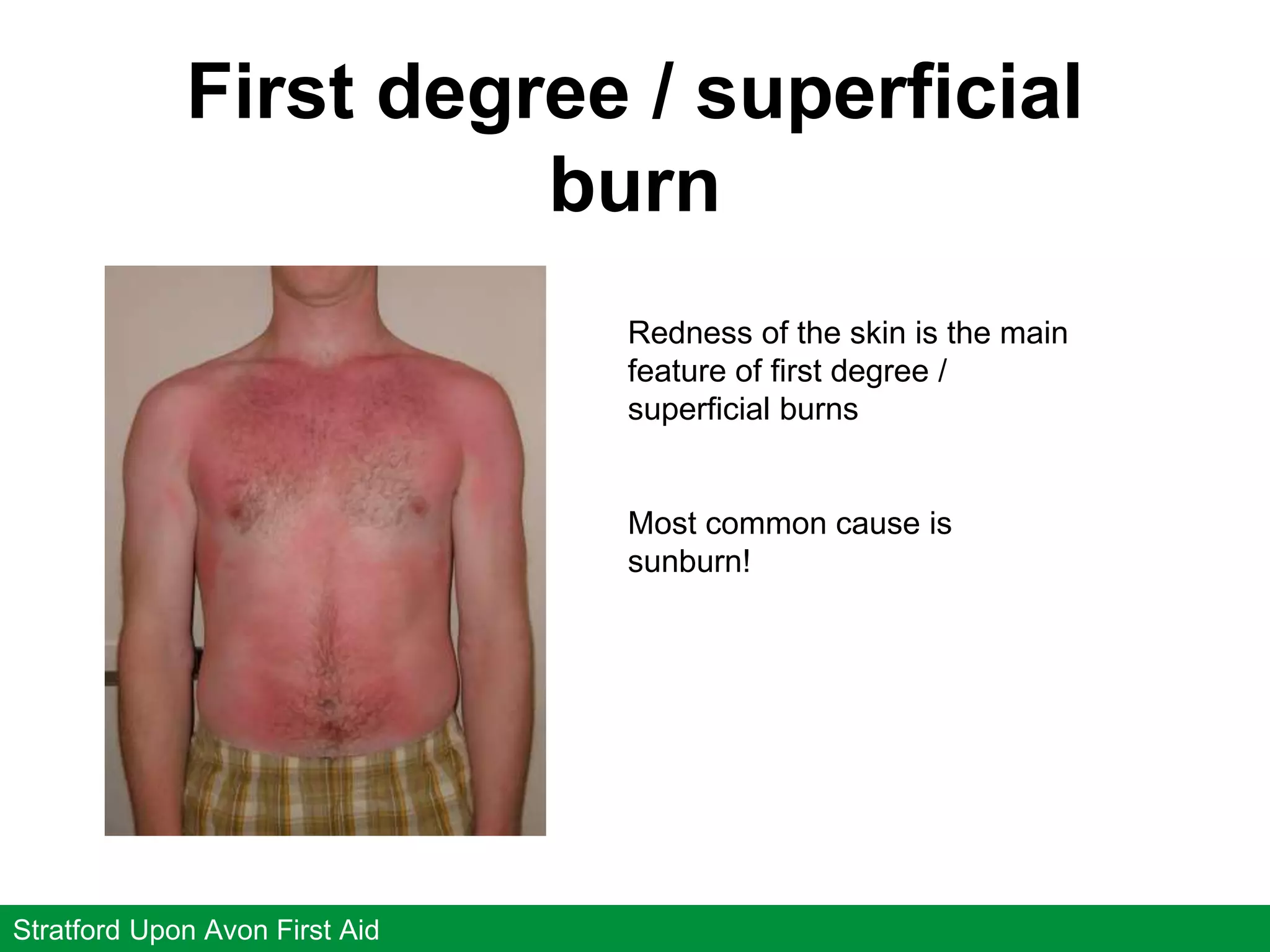 First Aid For Burns Ppt