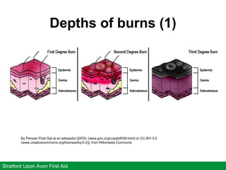First aid for burns | PPTX