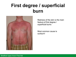 First aid for burns | PPTX