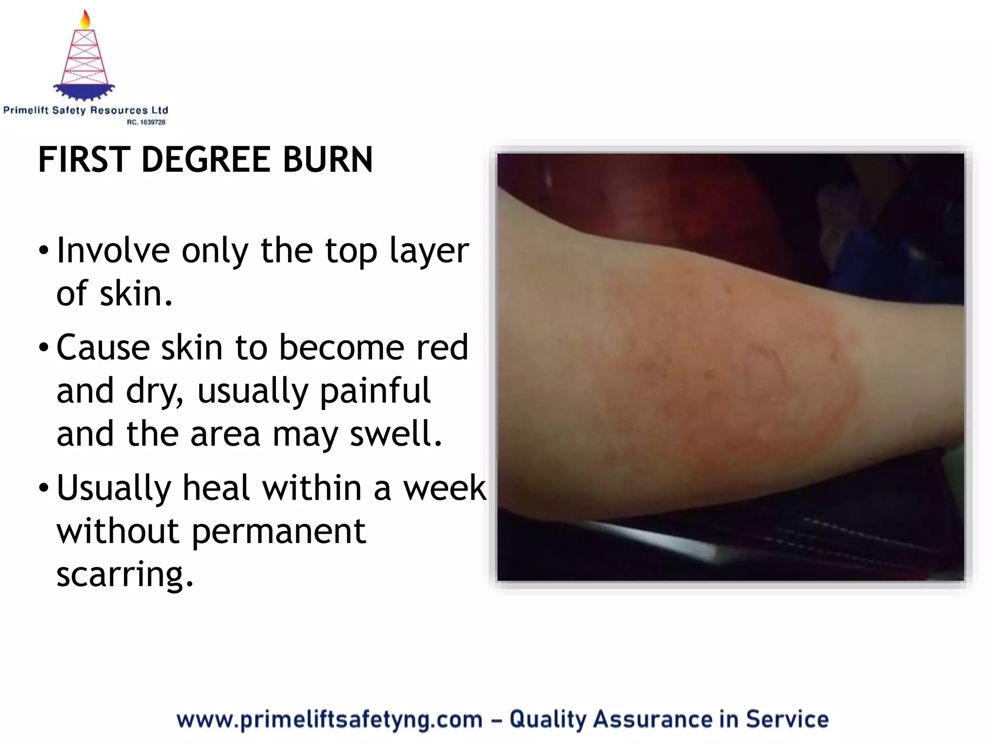 First Aid for Burns.pptx