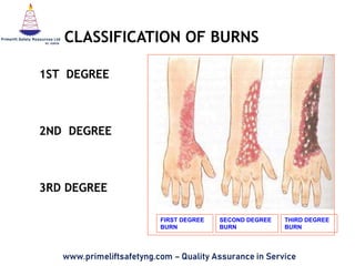 First Aid for Burns.pptx