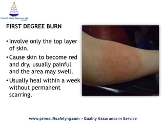 First Aid for Burns.pptx