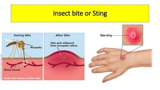 First aid for common injuries | PPTX