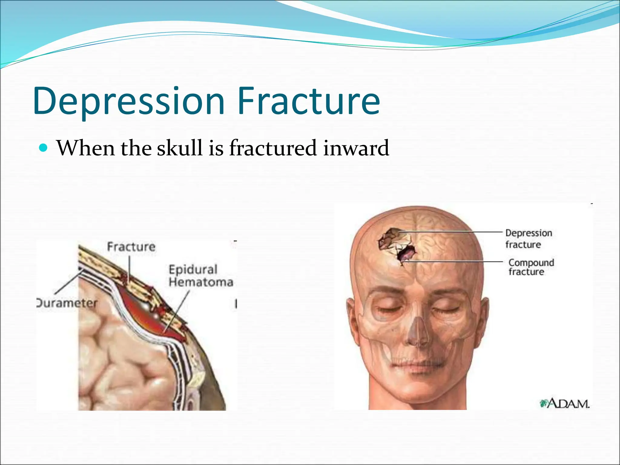 First aid FRACTURE.ppt4444444444444444444 | PPT