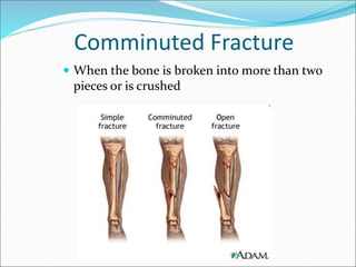 First aid FRACTURE.ppt4444444444444444444 | PPT