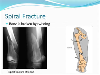 First aid FRACTURE.ppt4444444444444444444 | PPT