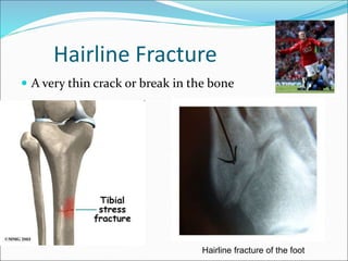First aid FRACTURE.ppt4444444444444444444 | PPT