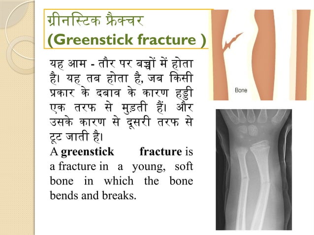FIRST AID FRACTURE and Basic Life Support pptx | PPT